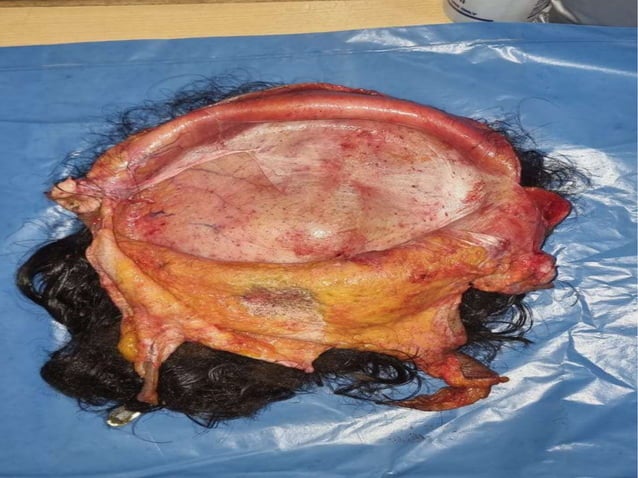 ENTANGLEMENT INJURIES .pptx