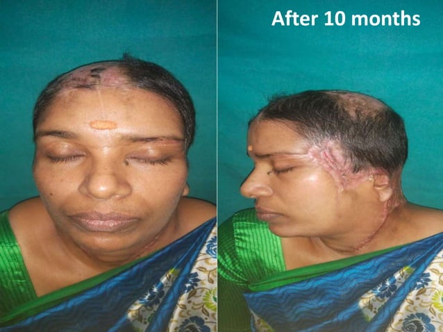 ENTANGLEMENT INJURIES .pptx