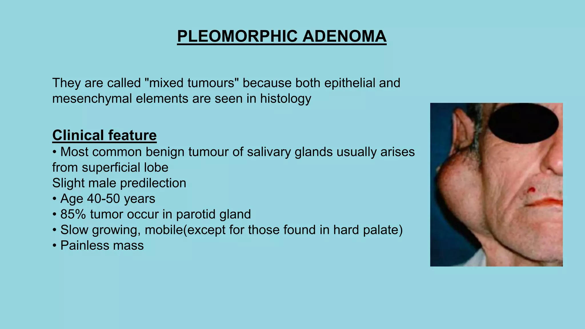 Parotid Gland ( Case and Basic Anatomy) | PPTX