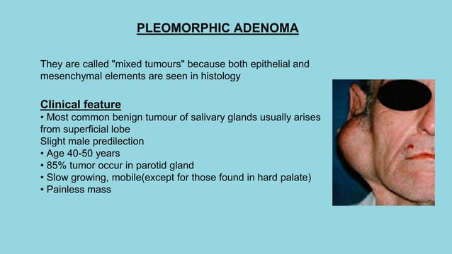 Parotid Gland ( Case and Basic Anatomy) | PPTX | Ear, Nose and Throat ...