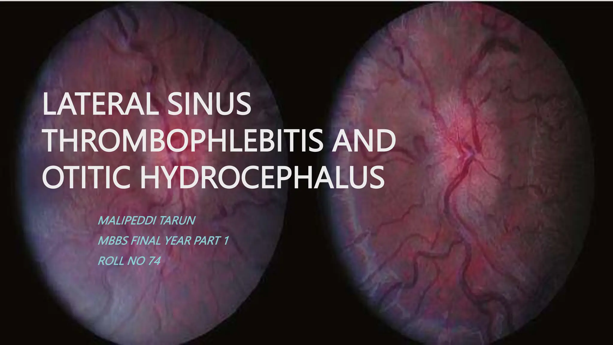 Lateral sinus thrombloplebitis and otitic hydrocephalus | PPTX