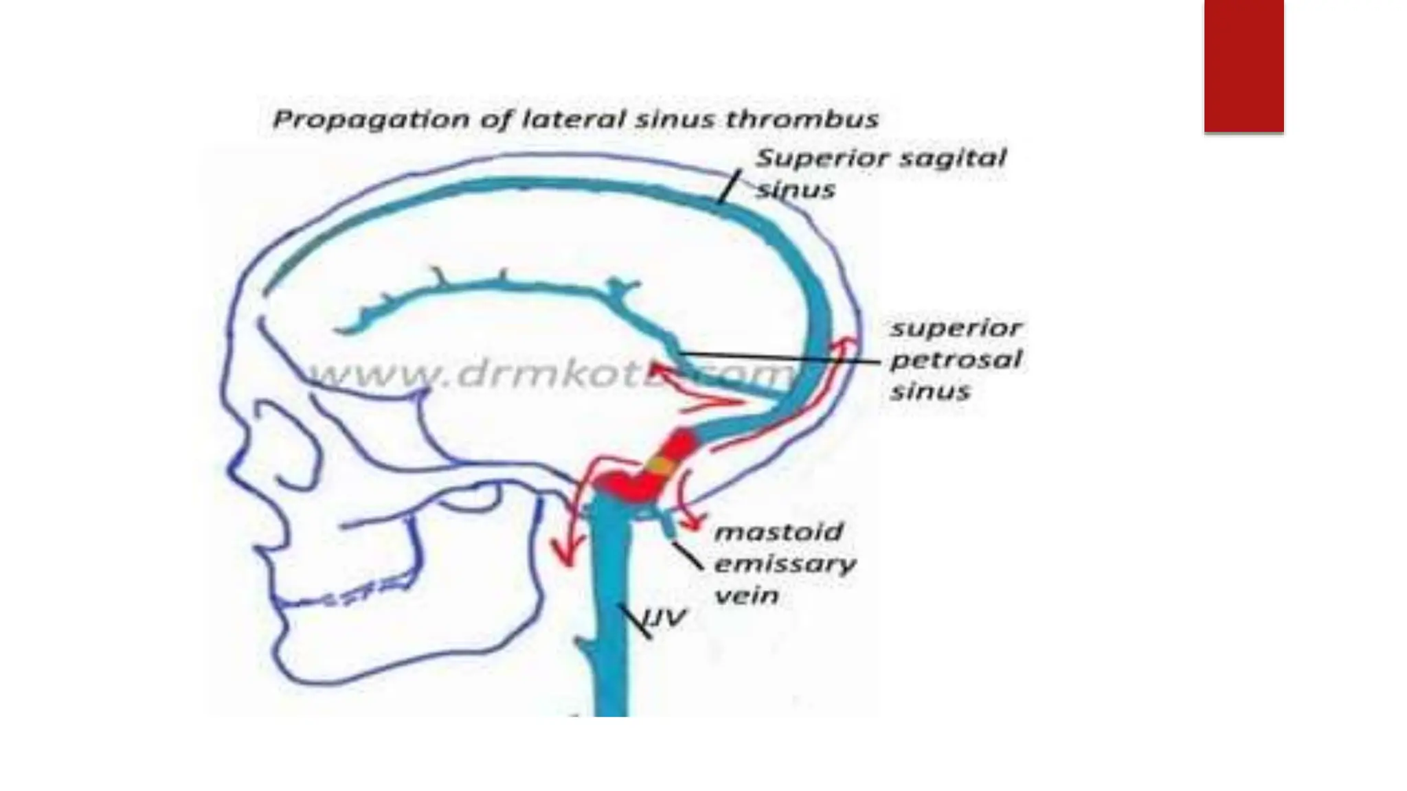 Lateral sinus thrombloplebitis and otitic hydrocephalus | PPTX