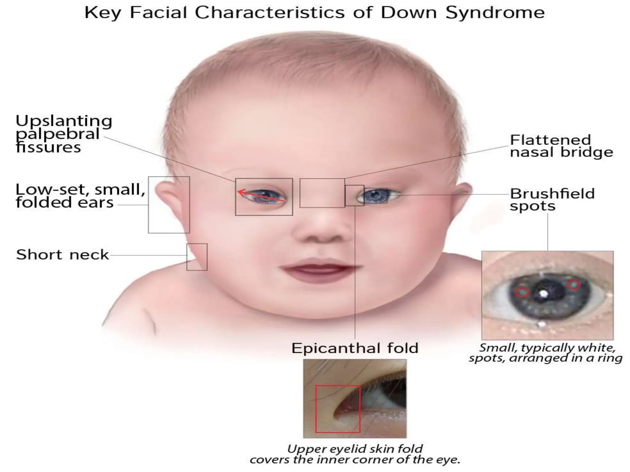 HEALTHCARE INITIATIVES RECOMMENDED FOR CHILDREN WITH DOWN'S SYNDROME. | PPT
