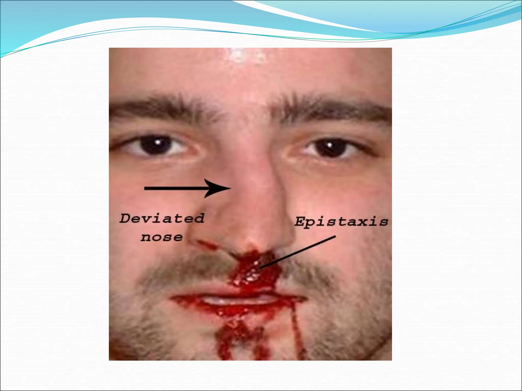 ENT Emergency 2020.pptx | Ear, Nose and Throat Conditions | Diseases ...