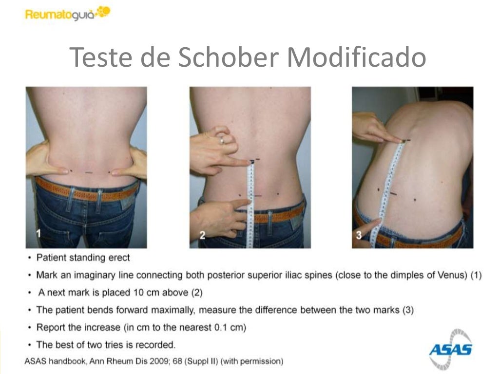 Entendendo a espondilite