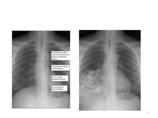 enteral and parenteral nutrition.pptx