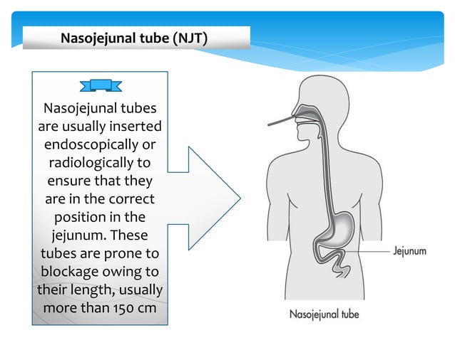 Enteral Feeding Tubes for Drug Administration | PDF