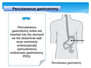 Enteral Feeding Tubes for Drug Administration | PDF