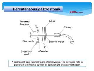 Enteral Feeding Tubes for Drug Administration | PDF