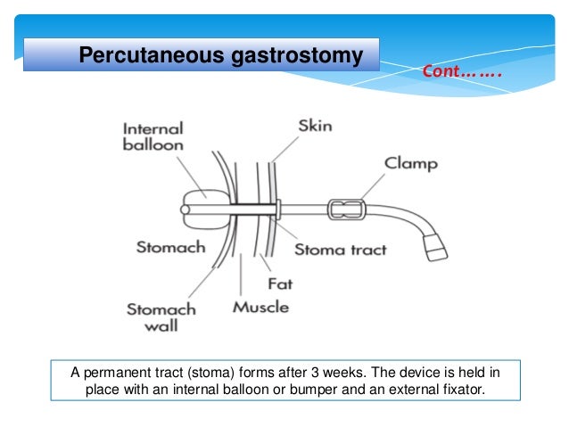 Enteral Feeding Tubes for Drug Administration