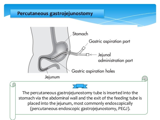 Enteral Feeding Tubes for Drug Administration