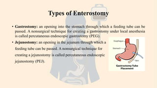 ENTERAL NUTRITION.pptx