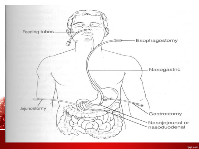 Enteral nutrition | PPT