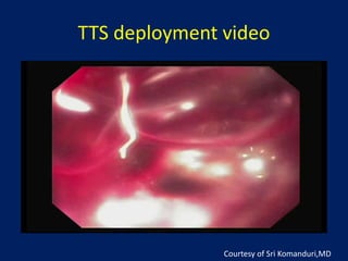 Enteral stenting | PPTX