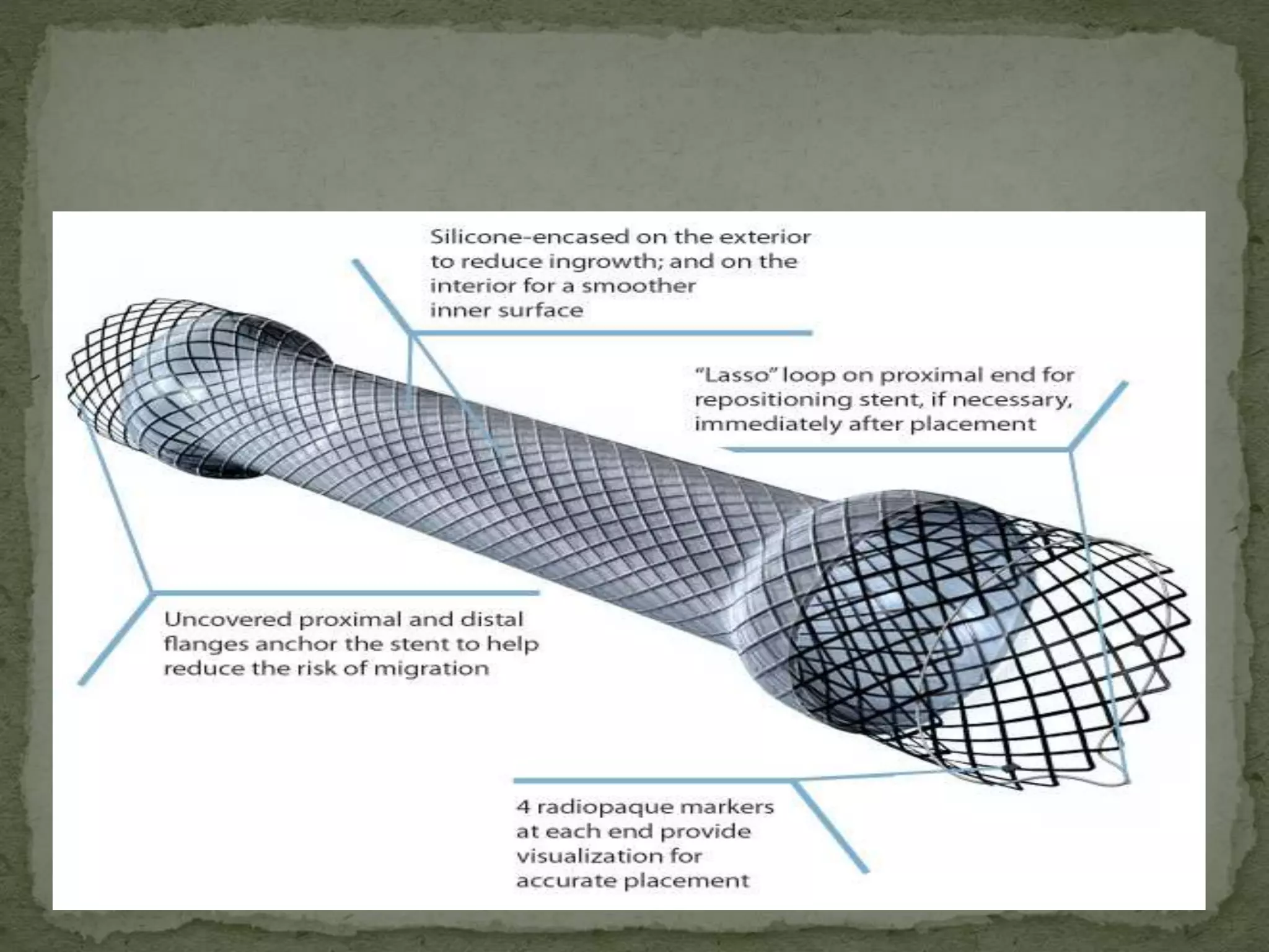 Enteral stents | PPTX