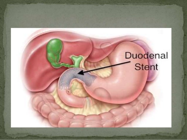 Enteral Stent Meaning – Enteral stents: Complications and their ...