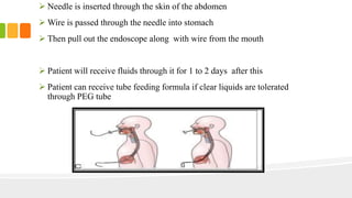 Enteral Tube Feeding | PPTX