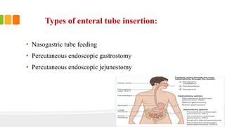 Enteral Tube Feeding | PPTX