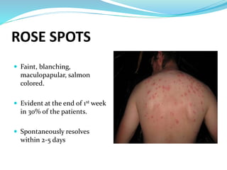 Typhoid Fever Rose Spots