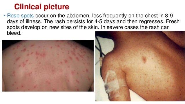 Enteric Fever by Dr. Sookun Rajeev Kumar