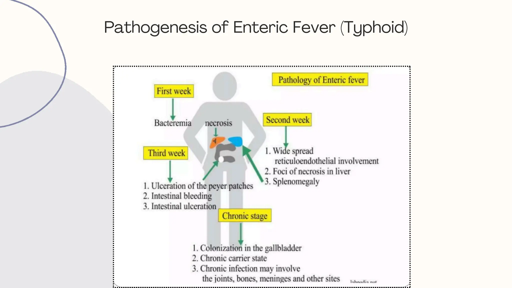 Enteric Fever – A Clinical Overview of Typhoid and Paratyphoid | PDF