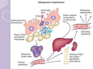 Enteric Fever, Typhoid and Paratyphoid Fever Etiology, Clinical course ...