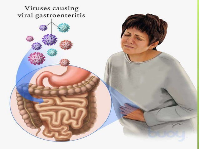 Gastro Enteritis.pptx | Digestive Disorders | Diseases and Conditions