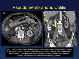 Enteritis and colitis | PDF
