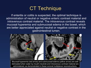 Enteritis and colitis | PDF