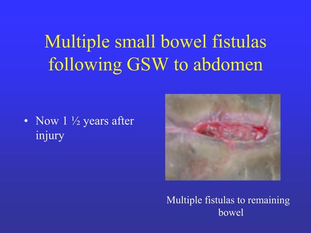 Entero-Atmospheric-Fistula, PPT.pdf