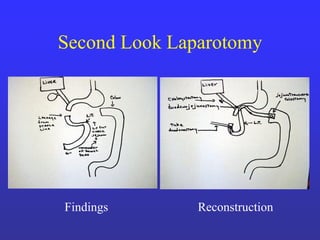 Entero-Atmospheric-Fistula, PPT.pdf