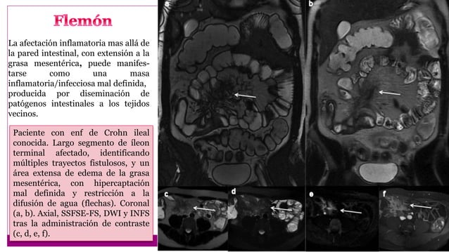 Entero resonancia en Enfermedad inflamatoria intestinal