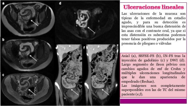 Entero resonancia en Enfermedad inflamatoria intestinal