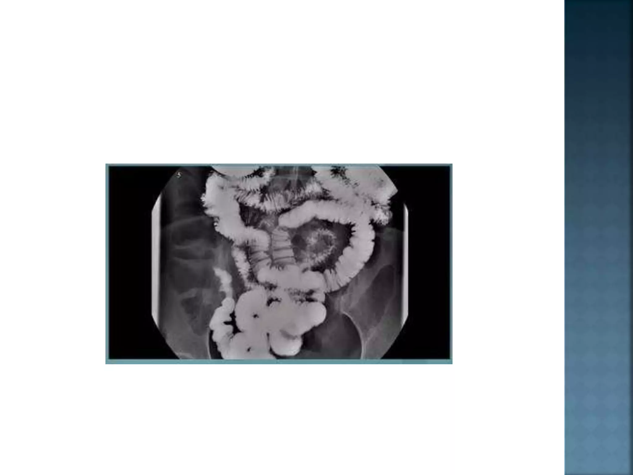 Enteroclysis | PPTX