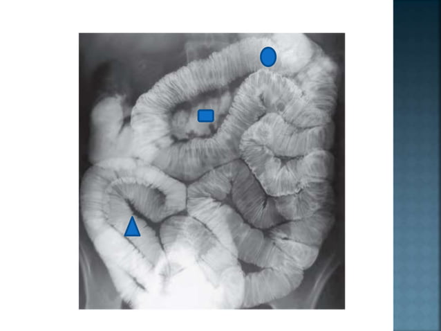 Enteroclysis | PPTX | Digestive Disorders | Diseases and Conditions