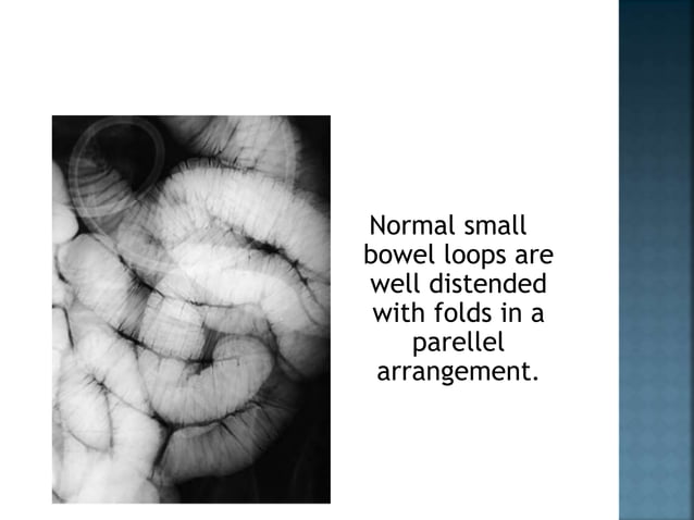 Enteroclysis | PPTX | Digestive Disorders | Diseases and Conditions