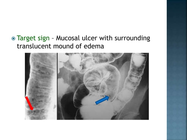 Enteroclysis | PPTX | Digestive Disorders | Diseases and Conditions