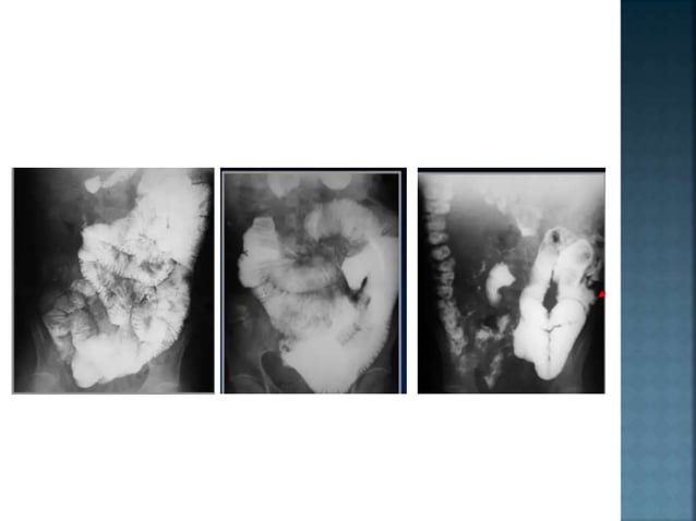 Enteroclysis | PPTX | Digestive Disorders | Diseases and Conditions