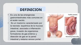 ENTEROCOLITIS, neonatal, medicina, repaso | PPTX