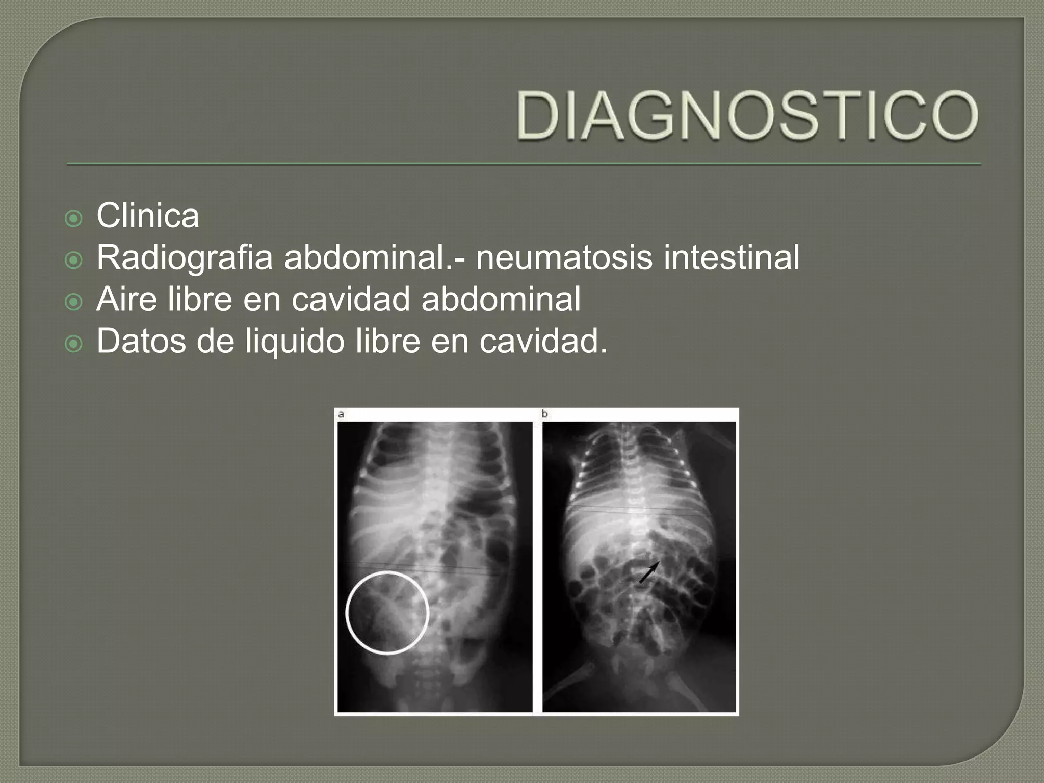 Enterocolitis necrosante | PPTX | Digestive Disorders | Diseases and ...