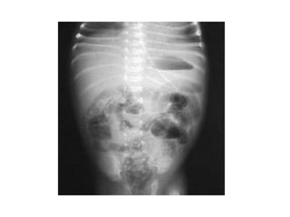 Enterocolitis Necrosante | PPTX