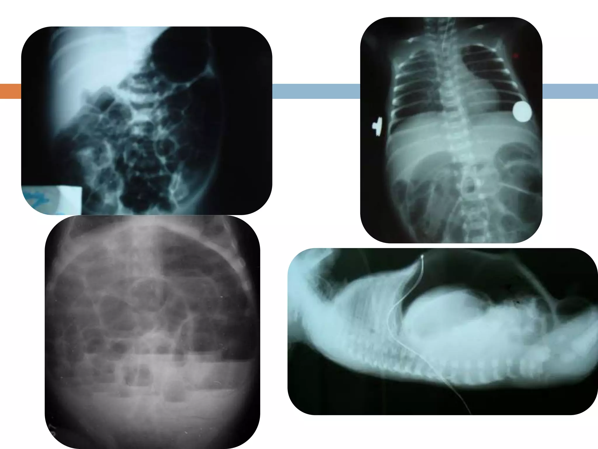 Enterocolitis necrosante neonatal | PPT