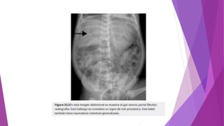 ENTEROCOLITIS NECROTIZANTE.pptx