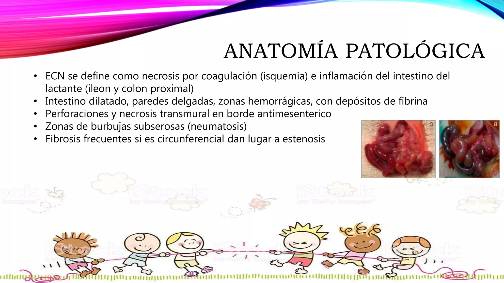 Enterocolitis necrotizante diapos | PPT