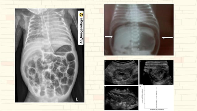 enterocolitis necrotizante neontal pediatria | PPT