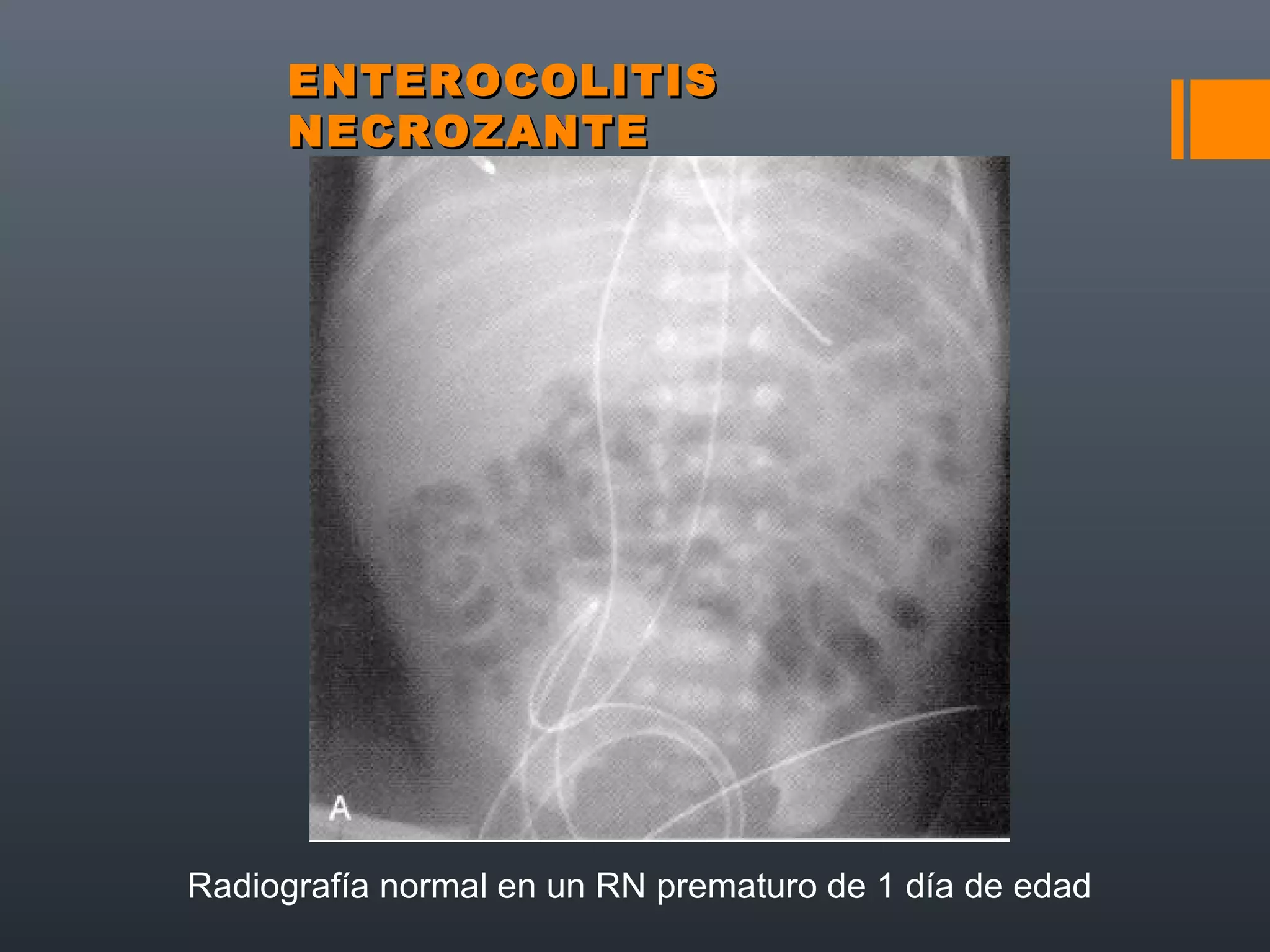 Enterocolitis necrozante | PPT | Digestive Disorders | Diseases and ...