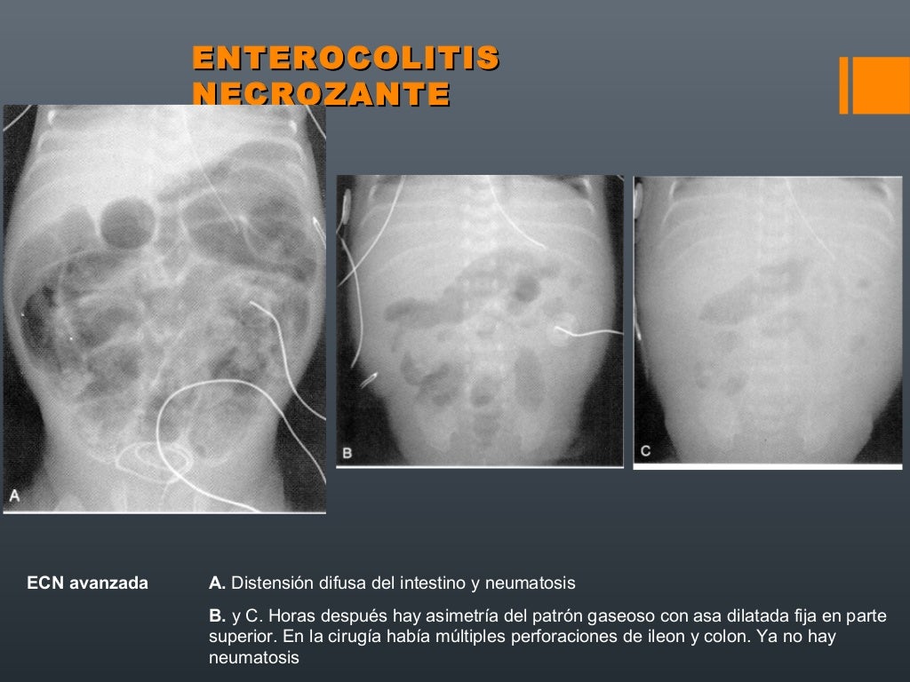 Enterocolitis necrozante