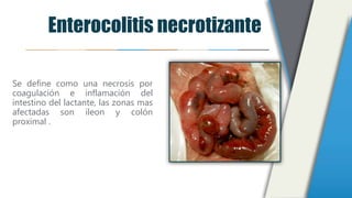 Enterocolitis Neonatal Necrotizante Pptx