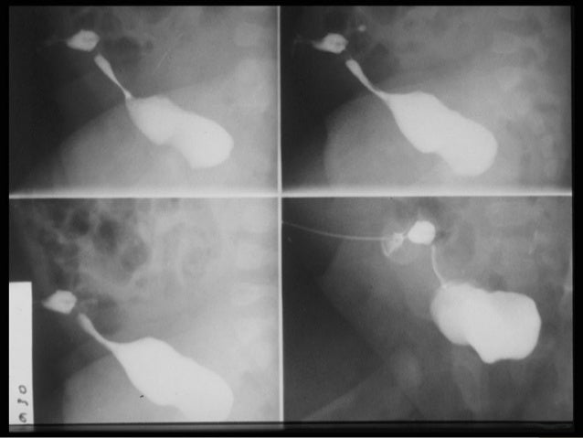 Enterocutaneous fistulas