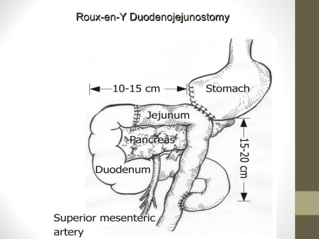 Enterocutaneous fistulas